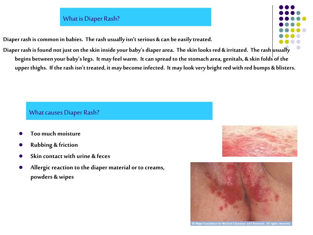 PPT - What is Diaper Rash? PowerPoint Presentation, free download - ID ...
