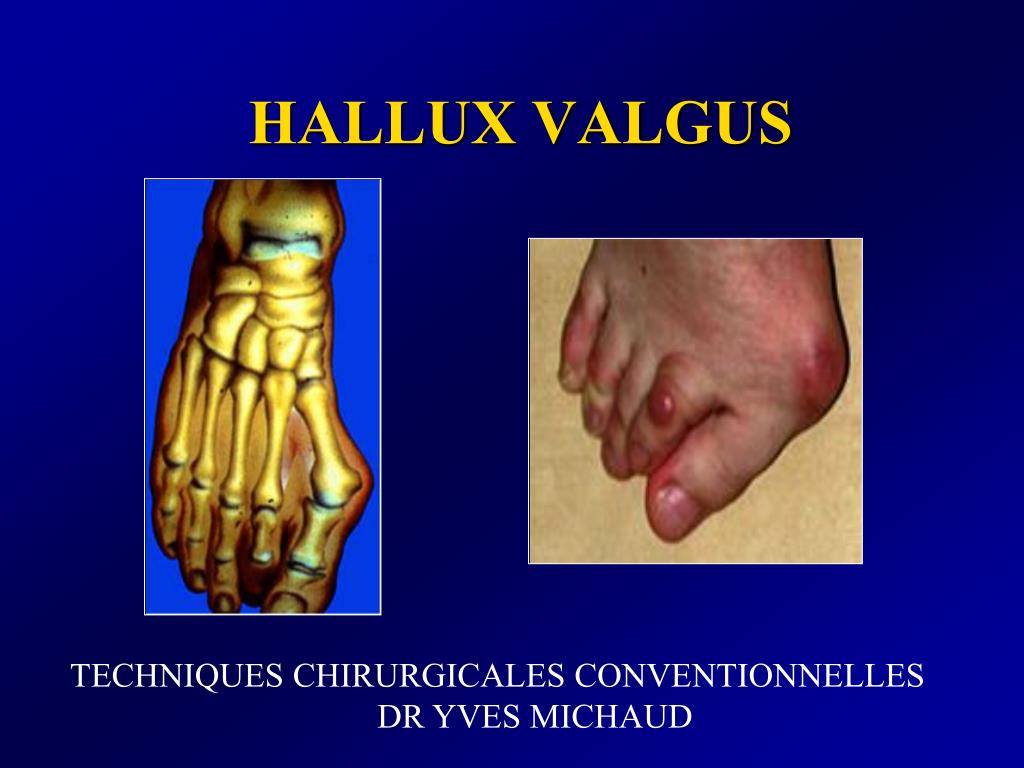 PPT - HALLUX VALGUS PowerPoint Presentation, free download - ID:5528050
