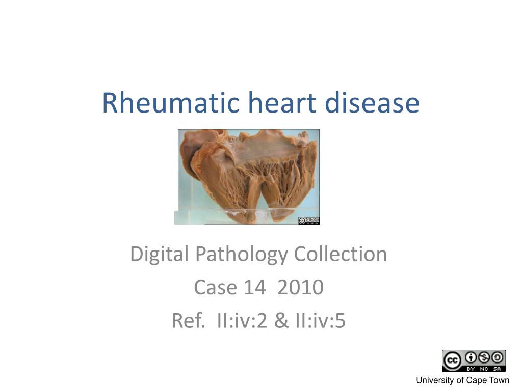 PPT - Rheumatic heart disease PowerPoint Presentation, free download ...