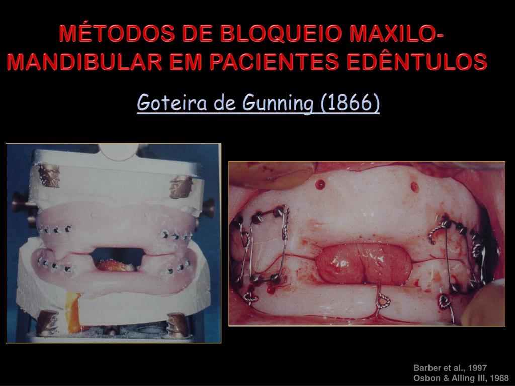 PPT - MÉTODOS DE BLOQUEIO MAXILO-MANDIBULAR EM PACIENTES EDÊNTULOS ...