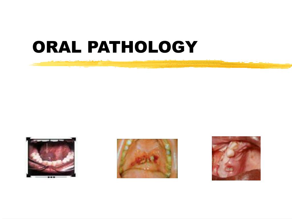 PPT - ORAL PATHOLOGY PowerPoint Presentation, free download - ID:5755148