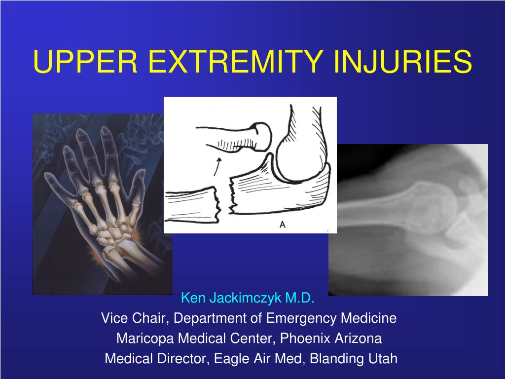 PPT - UPPER EXTREMITY INJURIES PowerPoint Presentation, free download ...
