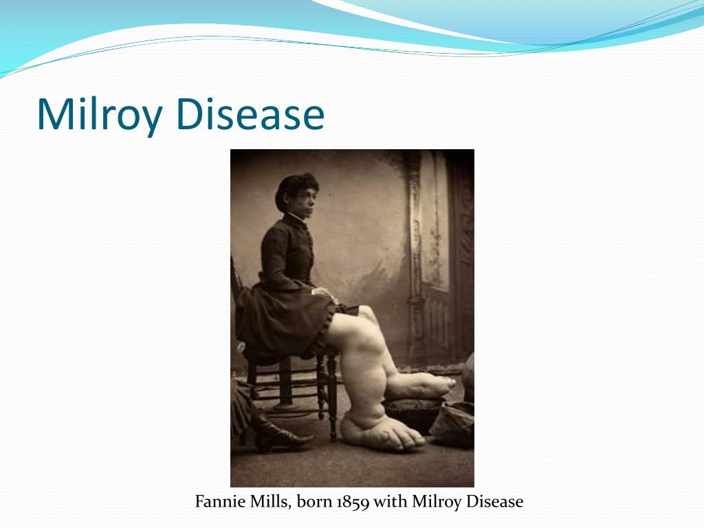 PPT - Milroy Disease PowerPoint Presentation, free download - ID:5917485