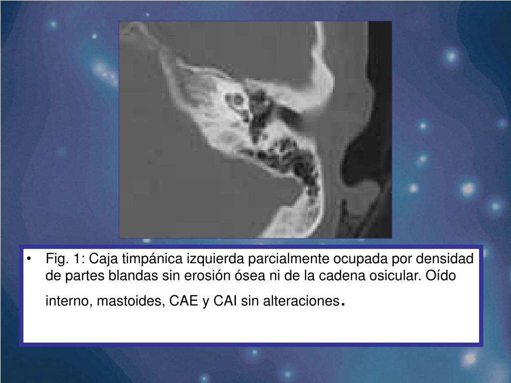 PPT - Fig. 10c: colesteatoma del ático del oído medio derecho ...