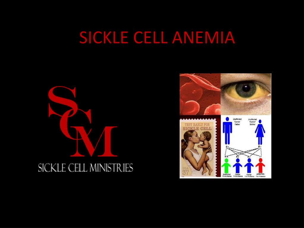 PPT - SICKLE CELL ANEMIA PowerPoint Presentation, free download - ID ...
