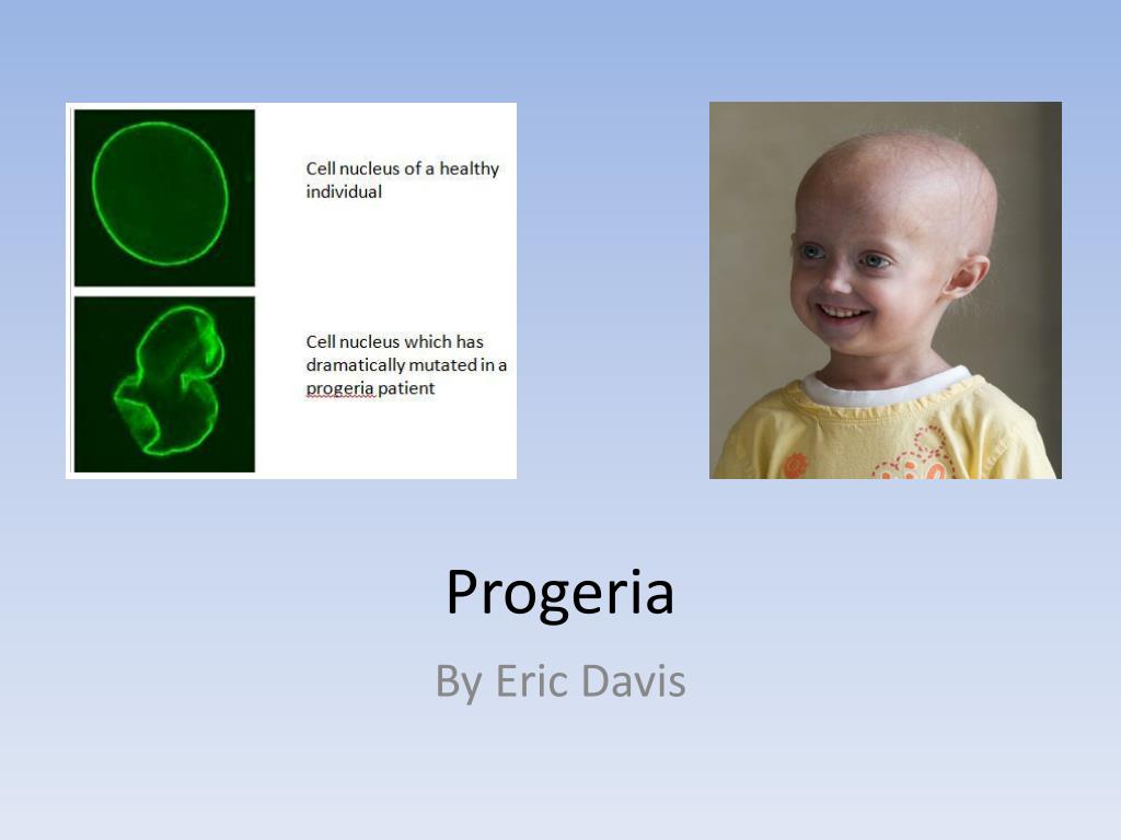 PPT - Progeria PowerPoint Presentation, free download - ID:6137295