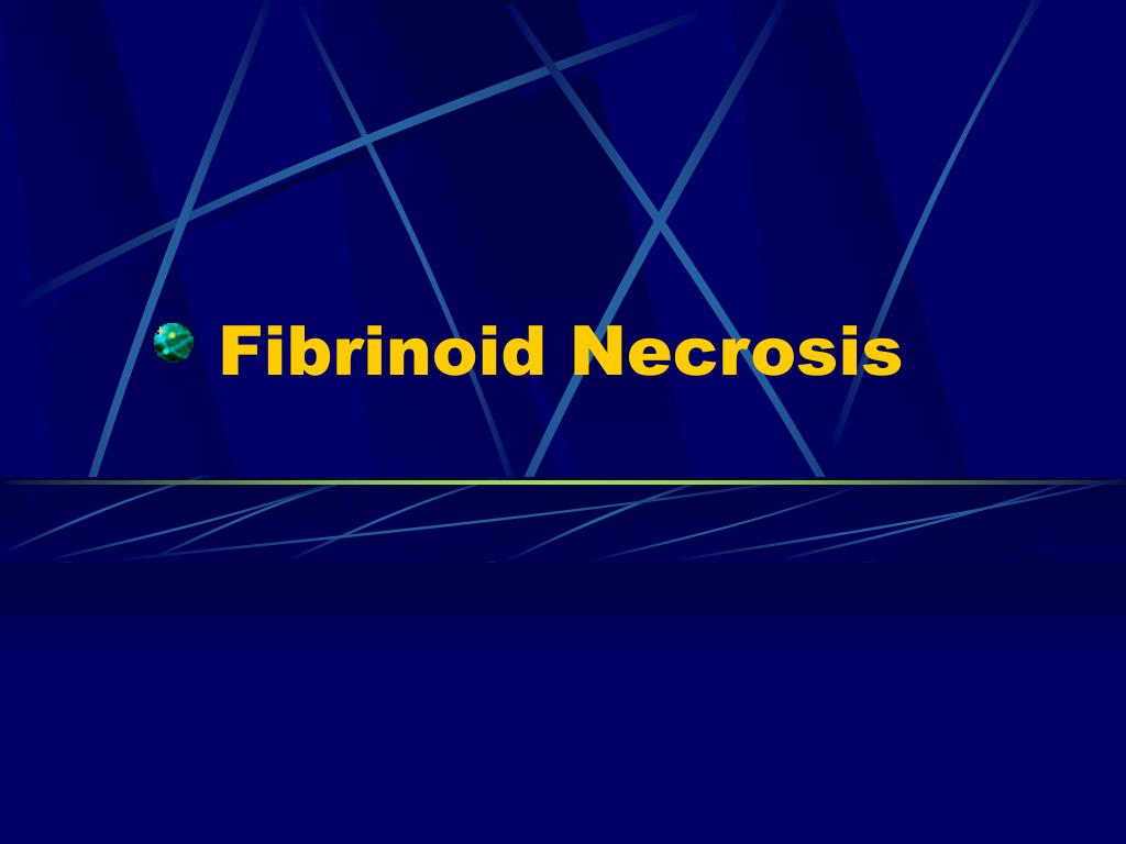 PPT - Fibrinoid Necrosis PowerPoint Presentation, free download - ID ...