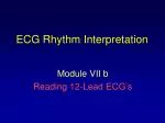 PPT - ECG Rhythm Interpretation PowerPoint Presentation, free download ...