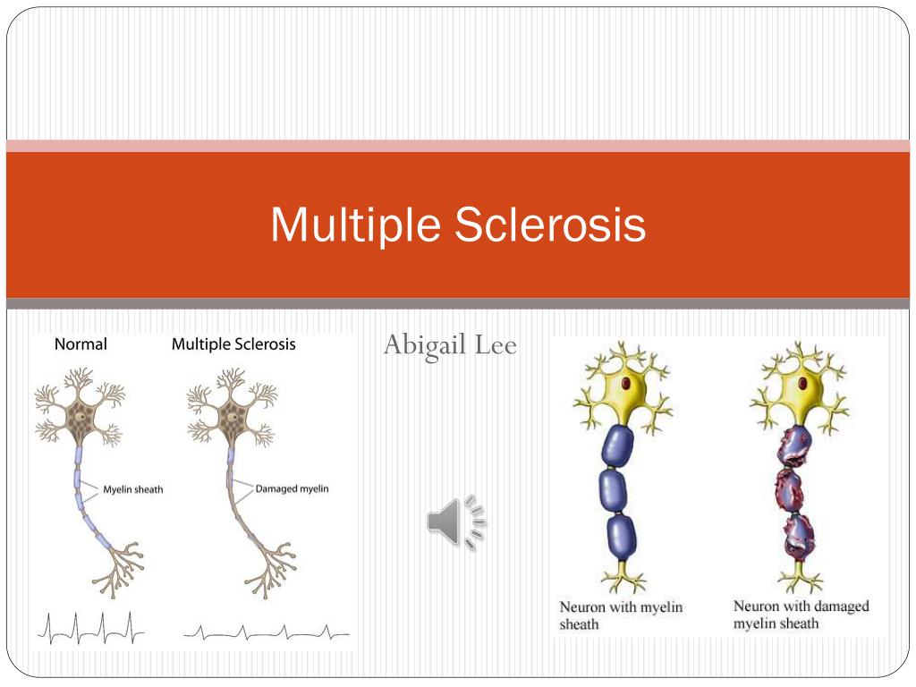 PPT - Multiple Sclerosis PowerPoint Presentation, free download - ID ...
