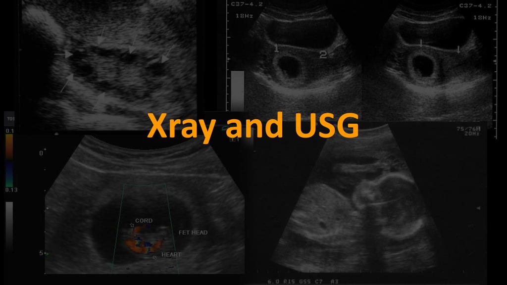 PPT - Xray and USG PowerPoint Presentation, free download - ID:6346934