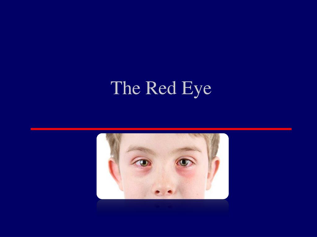 PPT - The Red Eye PowerPoint Presentation, free download - ID:6636277