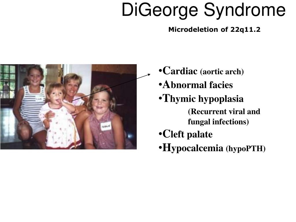 PPT - DiGeorge Syndrome PowerPoint Presentation, free download - ID:6701540