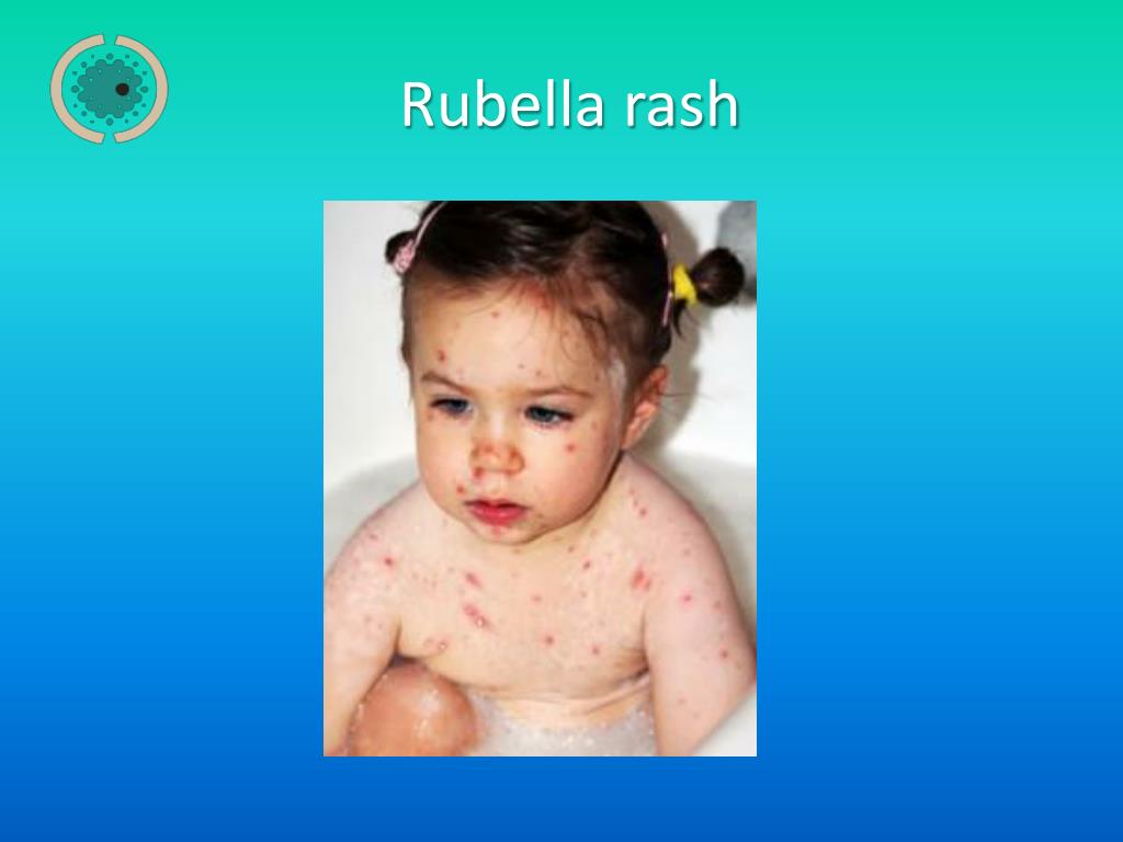 PPT - Rubella rash PowerPoint Presentation, free download - ID:6712774