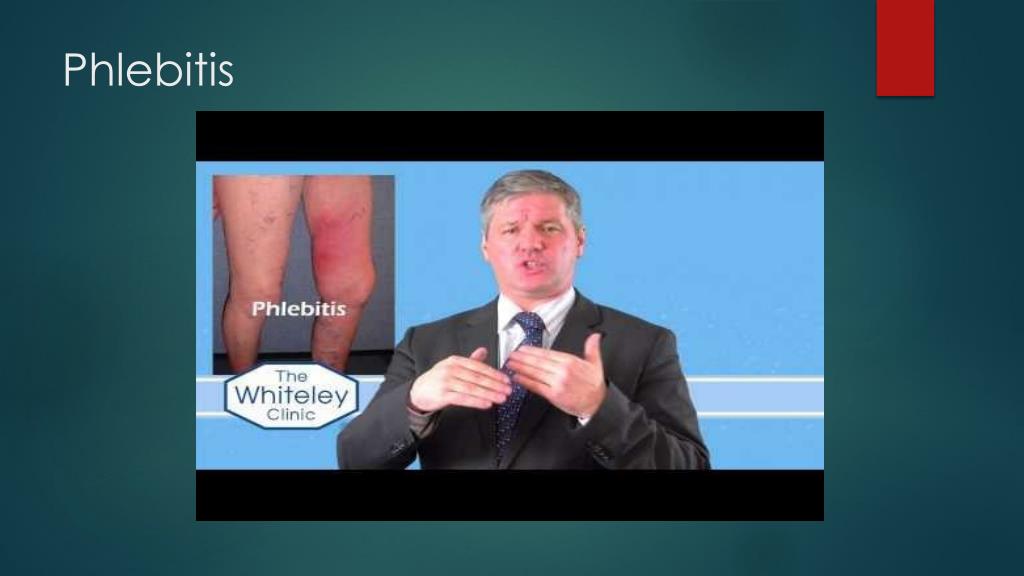PPT - Phlebitis PowerPoint Presentation, free download - ID:6850894