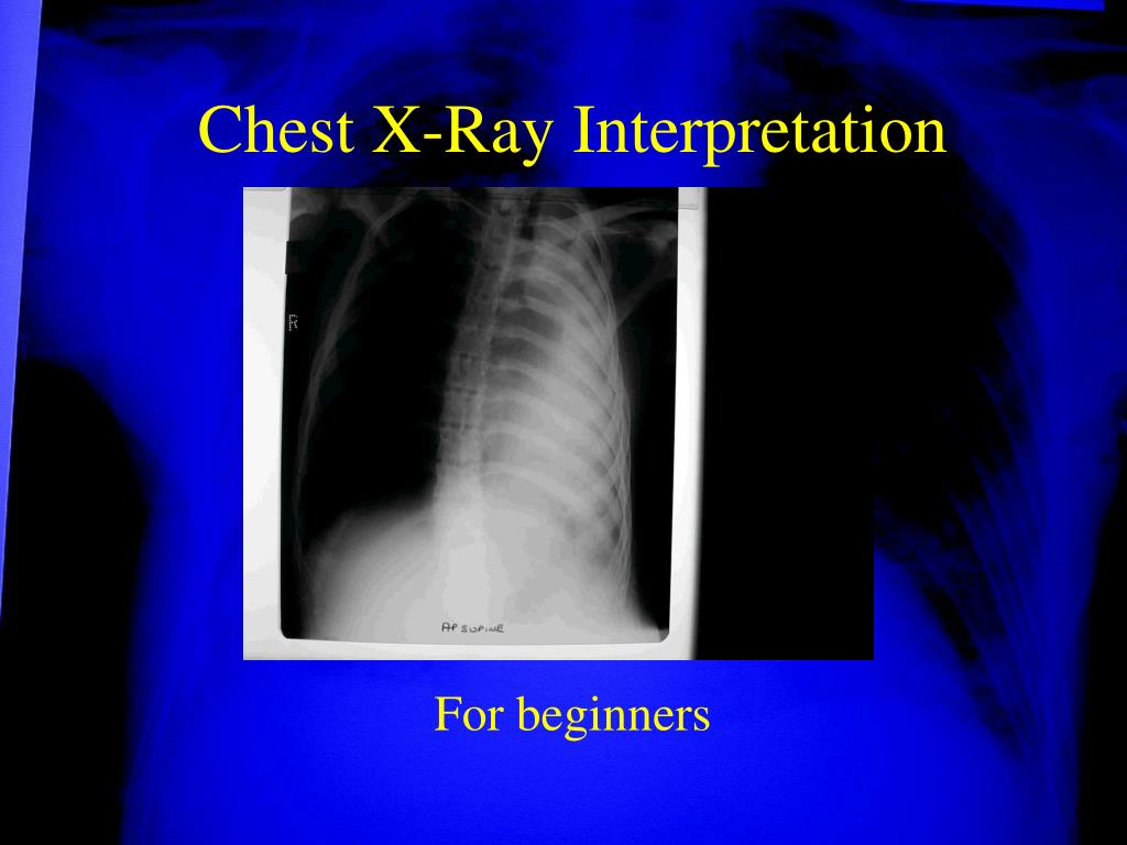 PPT - Chest X-Ray Interpretation PowerPoint Presentation, free download ...