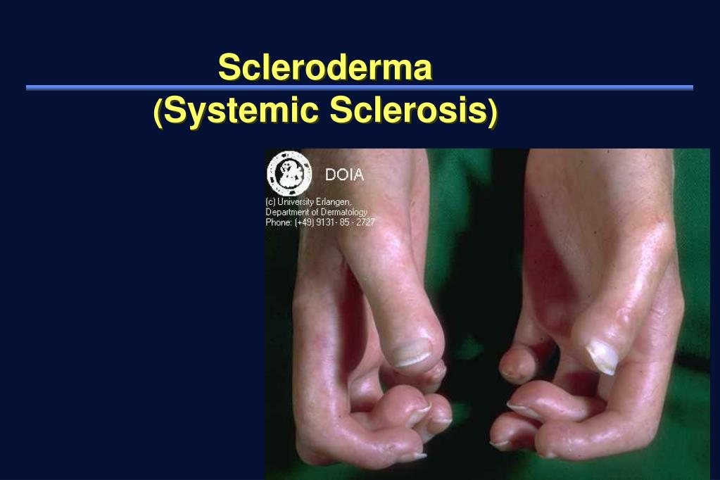 PPT - Scleroderma ( Systemic Sclerosis ) PowerPoint Presentation, free ...