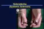 PPT - 2013 Classification Criteria for Systemic Sclerosis PowerPoint ...