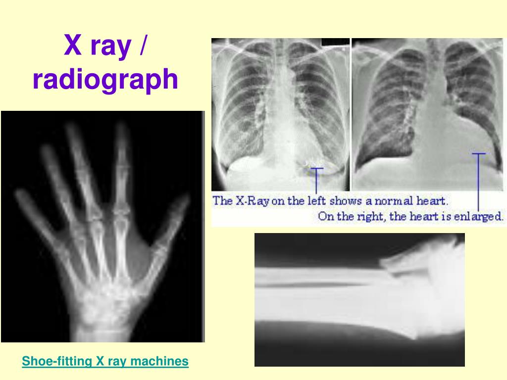 PPT - X ray / radiograph PowerPoint Presentation, free download - ID ...