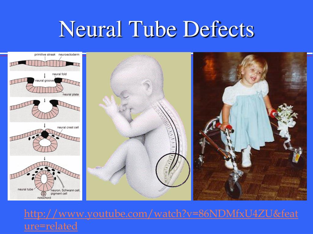 PPT - Neural Tube Defects PowerPoint Presentation, free download - ID ...