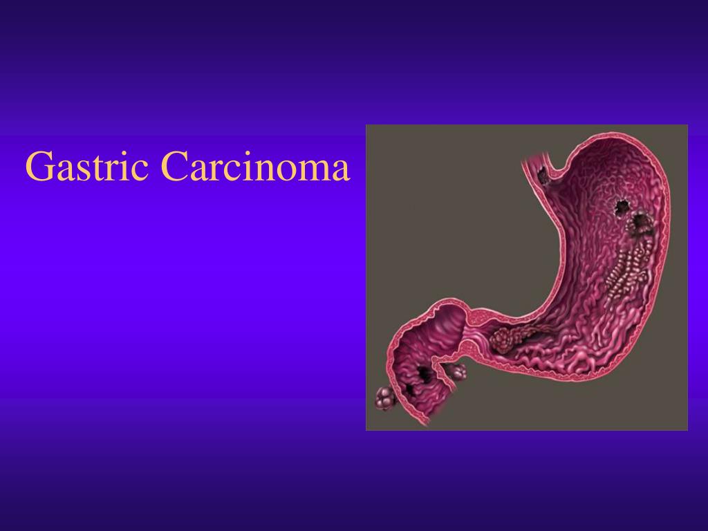 PPT - Gastric Carcinoma PowerPoint Presentation, free download - ID:6981645