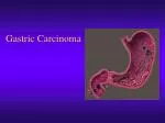 PPT - GASTRIC CARCINOMA PowerPoint Presentation, free download - ID:5732540